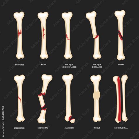 Set Of Different Types Of Bone Fracture Collection Diagram Of Leg