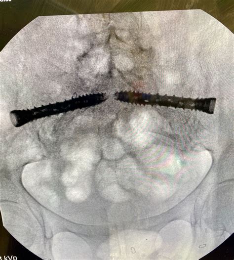 Sacral Insufficiency Fracture Dysmorphic Sacrum Treated With Bilateral 10x70mm Ifuse Torq