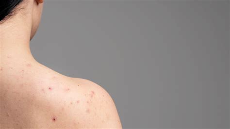 Why Do Red Spots Appear On Skin And How To Get Rid Of Them Kappers