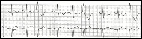 Ekg Rhythm Strip Quiz 153