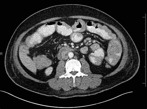 Initial Abdominal Pelvic Computed Tomography Showing Diffuse Colonic Download Scientific