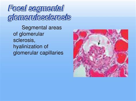 Ppt Glomerulopathies Vs Glomerulonephritis Powerpoint Presentation Free Download Id3303528