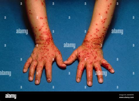 Herpes On Palms Of Hands