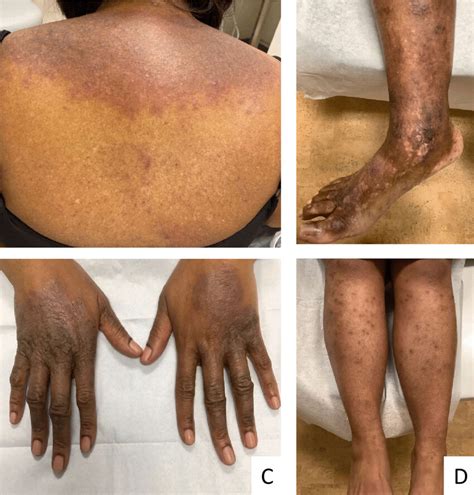 Clinical Presentation Of Atopic Dermatitis In Skin Of Color A Download Scientific Diagram