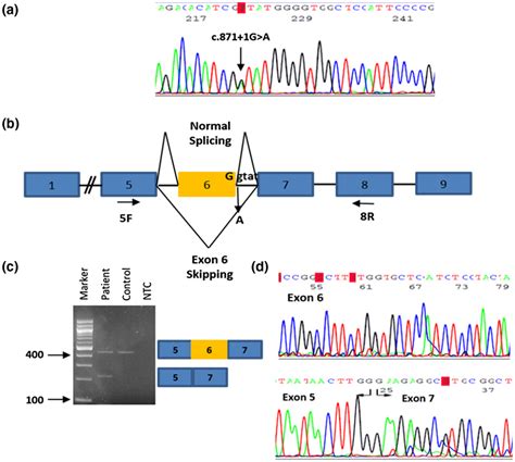 A Sanger Sequencing Electropherogram Showing The Novel Splice Site