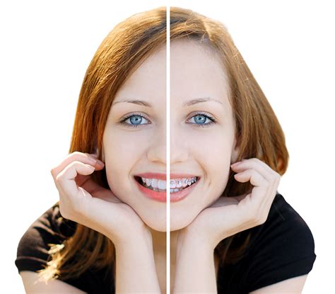 Invisalign Vs Braces Warsaw In Dental Solutions