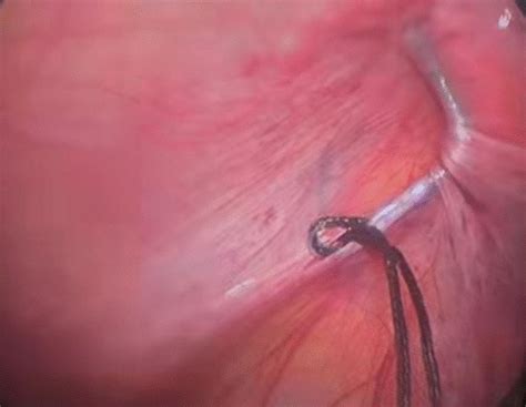 The Second Thread Loop Had Been Captured By The First Thread Loop Download Scientific Diagram