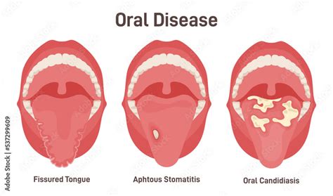 Tongue Problems Set Fissured Tongue Oral Candidiasis And Aphthous