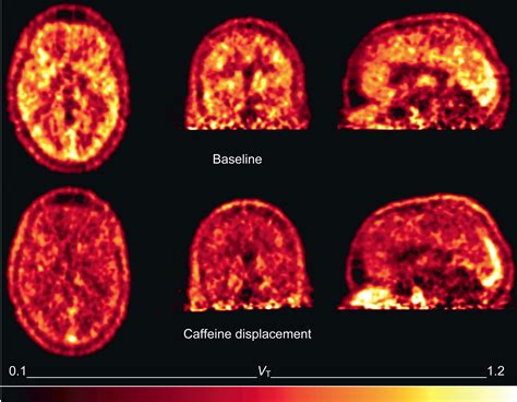 Cyberounds Researchers See Caffeine S Effect In The Brain
