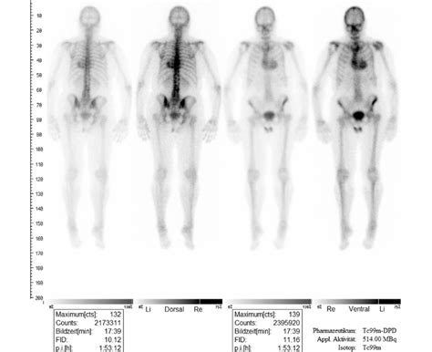 Planar 99mtc Mdp Scan Reveals Perugini Grade 3 Myocardial Uptake Download Scientific Diagram