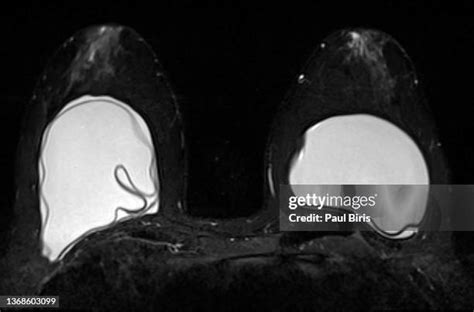 Mammogram Image Photos And Premium High Res Pictures Getty Images