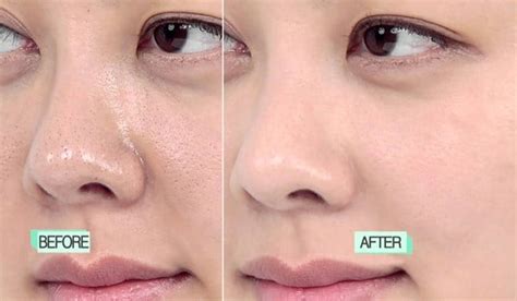 18 Home Remedies To Get Rid Of Clogged Pores Naturally