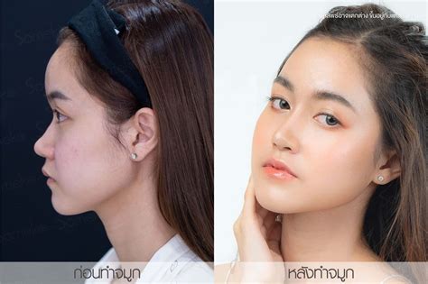 รีวิวเสริมปลายจมูก คุณเอบีซี โดยแพทย์ดีอีเอฟ ที่ Jirakorn Clinic Jirakorn Clinic