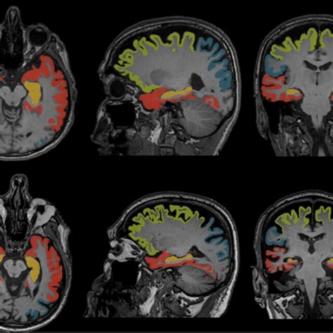 Samples Of Brain Segmentation By Icometrix® Of A Healthy Control A Download Scientific
