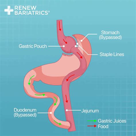Sleeve Gastrectomy Vs Gastric Bypass