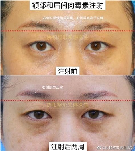 今日案例，全切双眼皮 上睑眶隔脂肪释放 左侧泪腺复位悬吊。 知乎
