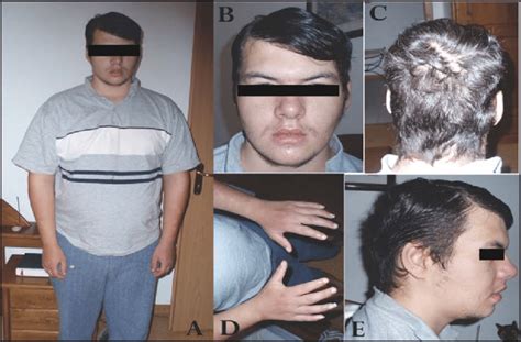 Xxyy Syndrome Symptoms