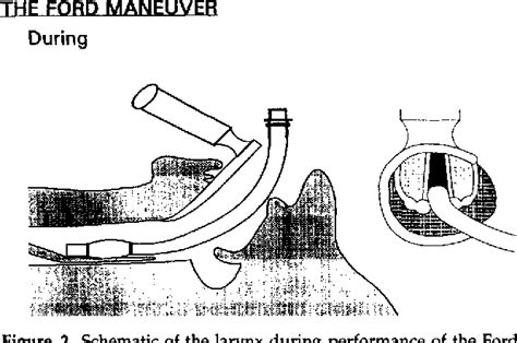 Anterior Larynx Difficult Intubation