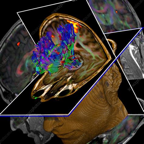 Brain Tumour Dti And Mri Scans Stock Image C0068350 Science Photo Library