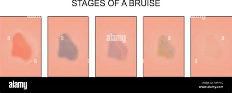 Vector Illustration Of The Stages Of Healing Of A Bruise Stock Vector Image And Art Alamy