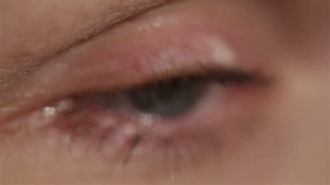 Conjunctivitis Stock Video Footage For Free Download