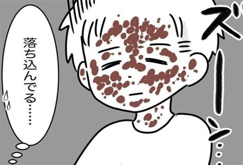 手足口病は子どもだけの病気じゃなかった発疹だらけになった夫の体験を漫画化 ママリ