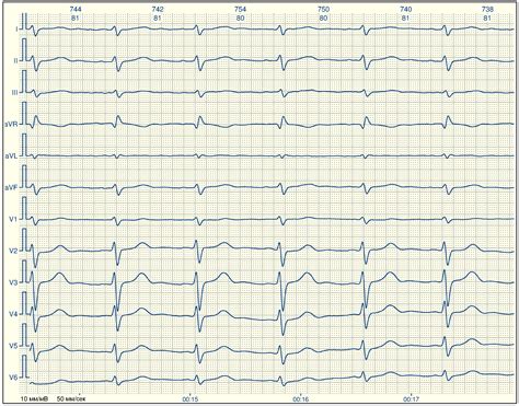 Ekg S1 S2 S3 Muster S1 S2 S3 Typ Ekg Kuye