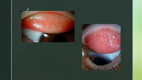 Conjuntivitis Alergica Presentacionpptx Eye And Vision Conditions