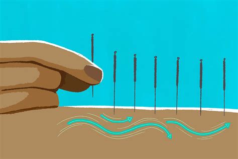 Dry Needling Vs Acupuncture Everything You Need To Know Nike In