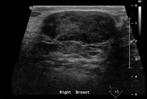 Medical Ultrasound Fibroadenoma Breast