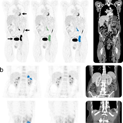 Examples Of Automated Lesion Segmentation A Example Showing Download Scientific Diagram