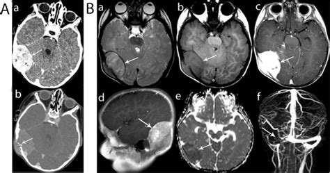 A Preoperative Axial Contrast Enhanced Soft Tissue Window A And Bone