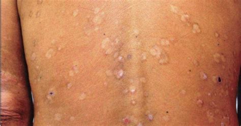 Cutaneous Onchocerciasis Image