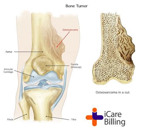 The Two Most Common Types Of Bone Cancer That Develop During Adolescence Are Osteosarcoma