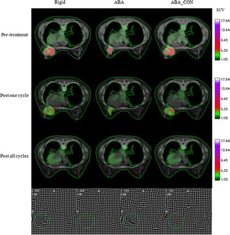 Results Of The Three Registration Algorithms For Another Patient With Download Scientific