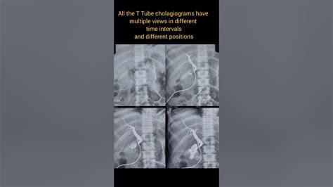 T Tube Cholangiogram Xray Youtube