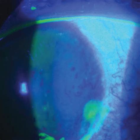 Dellen Effect Near The Scleral Nodule Download Scientific Diagram