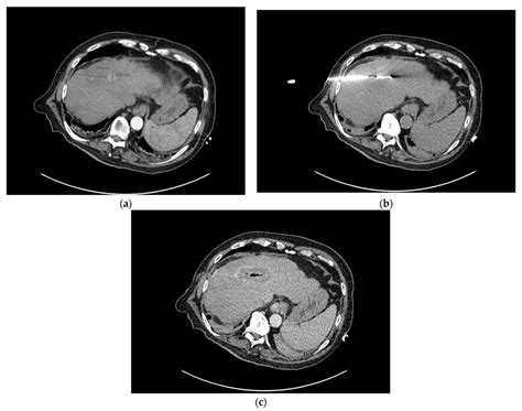 A Planning Ct For Microwave Ablation Of Solitary Hepatocellular