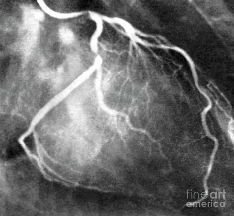 Coronary Artery Stenosis Photograph By Zephyr Science Photo Library Pixels