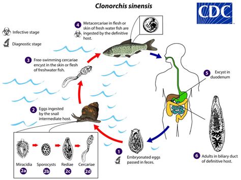 Clonorchiasis Clonorchis Sinensis Infection Symptoms Diagnosis