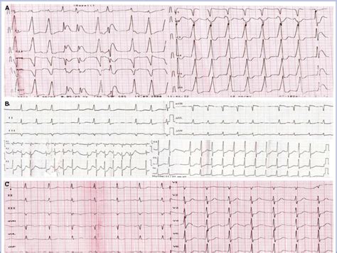 A The Electrocardiography Ecg Results Showing The Fast