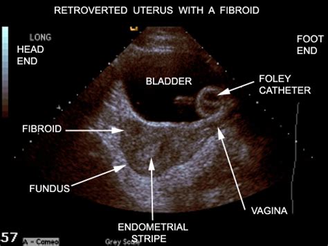 Uterine Fibroids Ultrasound