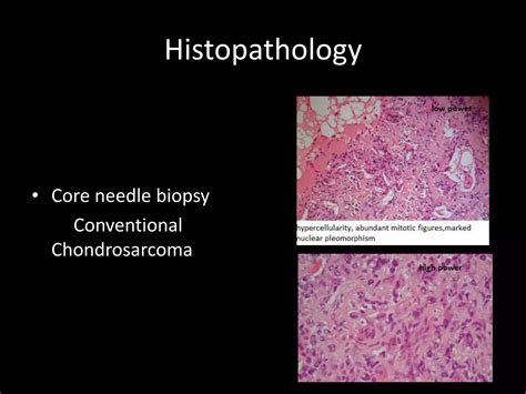 Chondrosarcoma Proximal Humerus Pptx