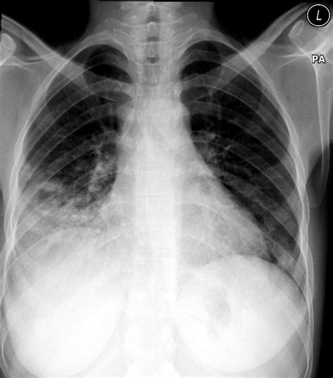 Chest X Ray Pneumonia