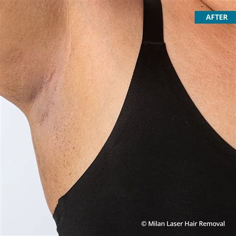 Underarm Before And After Photos Of Laser Hair Removal Milan Laser In Rockford Il