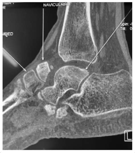 Ct Scans Confirming Tibiotalar And Talo Navicular Dislocations With