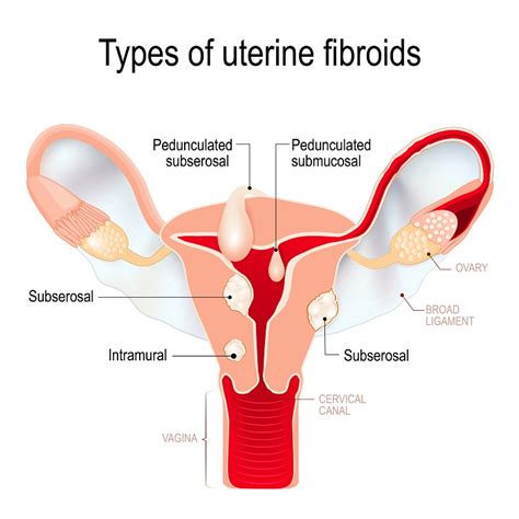 Fibroids Symptoms And 8 Natural Treatments David Avocado Wolfe