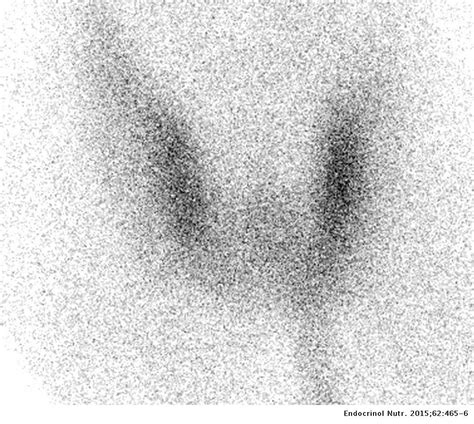Hyperthyroidism Induced By Topical Iodine Endocrinología Y Nutrición English Edition