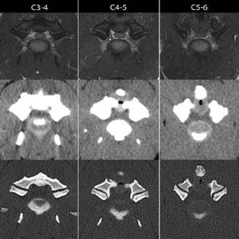 Transverse Mr And Ct Images At The Level Of C3 4 C4 5 And C5 6 With Download Scientific