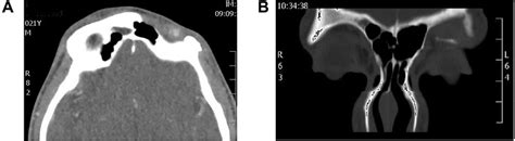 A Axial Ct Scan Showing Left Frontal Bone Osteomyelitis And B Ct